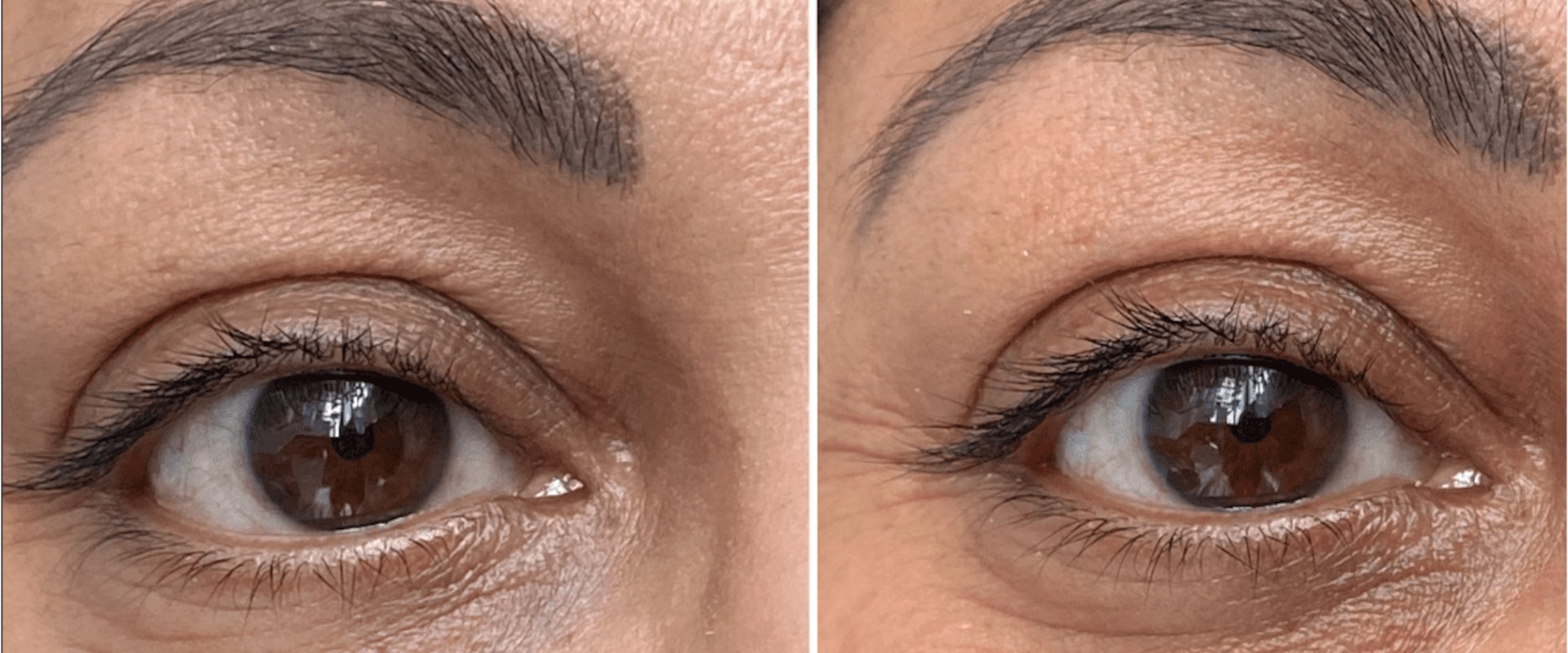 How long do polynucleotides last under eyes?
