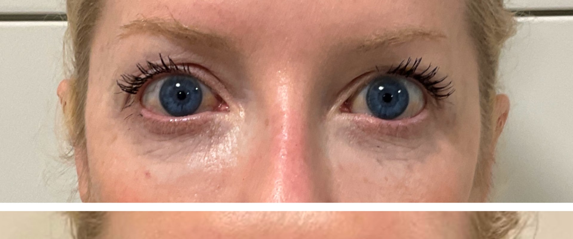 The Science Behind Long-Lasting Polynucleotide Treatment